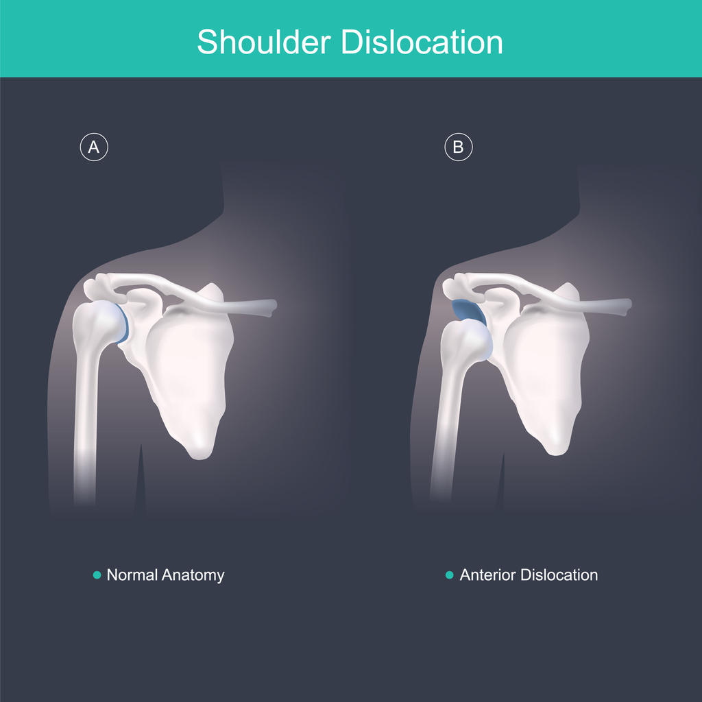 Dislocated Shoulder